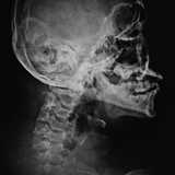 Teen’s vape explodes, shattering his jaw | The Dirty Truth
